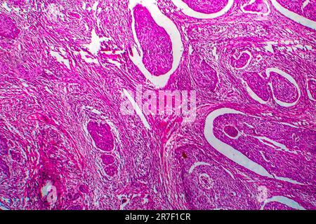 Gebärmutterhalskrebs. Licht Schliffbild (LM), einen Abschnitt über ein ...