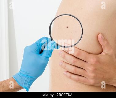Der Arzt untersucht die Wucherungen auf der Haut eines Erwachsenen mit ...