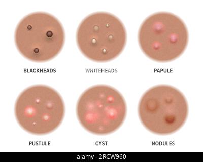 Arten von Akne Haut Entzündung. Pickel, Furunkel, Whitehead ...
