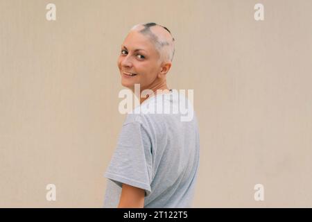 Echte Alopecia areata bei einem jungen Mädchen. Ein kahler Kopf in einer Person. Diffuse ...