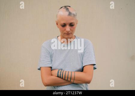 Echte Alopecia areata bei einem jungen Mädchen. Ein kahler Kopf in einer Person. Diffuse ...