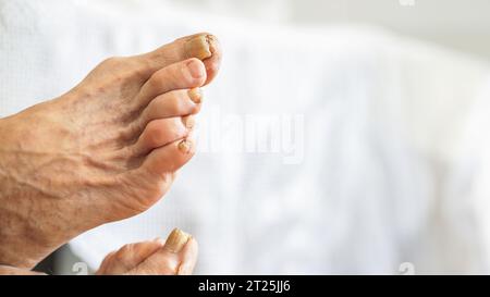 Nahaufnahme von erwachsenen Füßen mit verschiedenen Problemen, Kallus ...