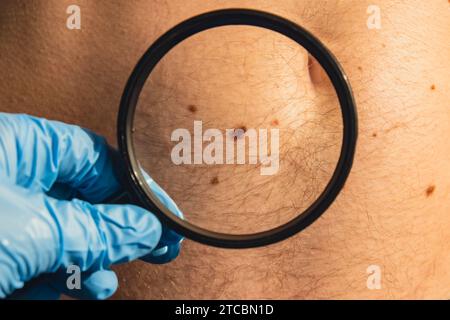 Unerkennbarer Dermatologe, der das Muttermal des Patienten mit Lupe in ...
