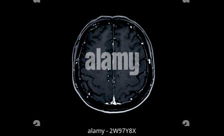 Die axiale Ansicht von MRT-Hirnscans bietet wertvolle Einblicke in ...