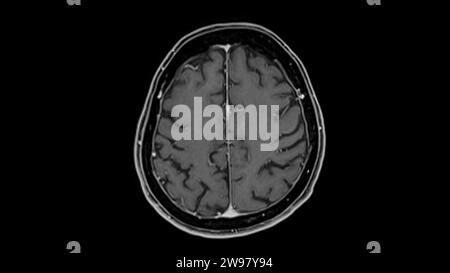 Die axiale Ansicht von MRT-Hirnscans bietet wertvolle Einblicke in ...