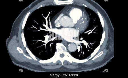 CTPA oder CTA Pulmonalarterie. Diese Bildgebungstechnik bietet eine ...