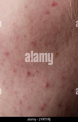 Pickel auf natürlicher Haut. Hautstruktur. Aknepickel am Rücken ...