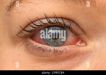 Gerötete Augen mit Symptomen einer Konjunktivitis oder einer anderen ...