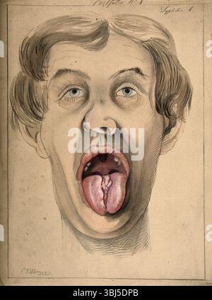 Das Gesicht eines Mannes, der an Syphilis leidet, wird mit weit ...