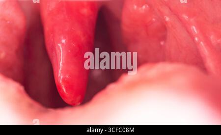 Rote, entzündete und geschwollene Uvula im Hals. Behandlung der ...