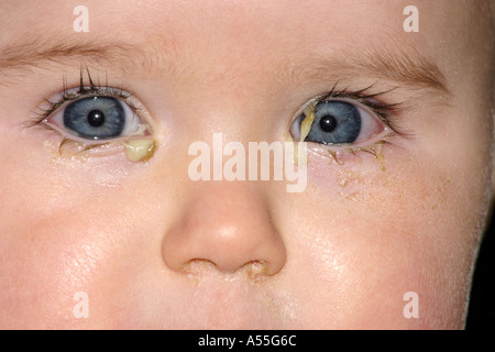 Bindehautentzündung-Infektion des Auges leiden Baby Stockfotografie - Alamy