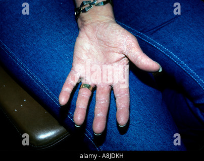 Scherpilzflechte Pilzinfektion der Haut Stockfotografie - Alamy