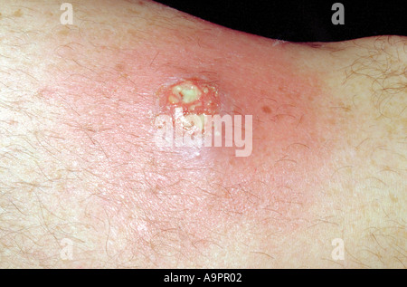 Ecthyma und Staph Aureus Furunkel HIV positiven Patienten ...