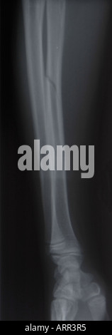 Röntgenbild einer distalen Unterarm-Fraktur Stockfotografie - Alamy