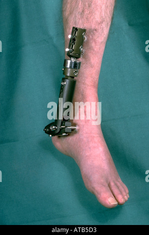 Externe Fixation der Tibia Stockfotografie - Alamy