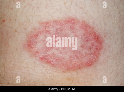 Scherpilzflechte Pilzinfektion der Haut Stockfoto, Bild: 17533980 - Alamy