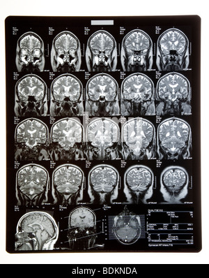 Mrt-Brain Scan von Kopf und Schädel Stockfotografie - Alamy