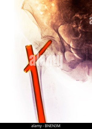 Hip Röntgen zeigt eine Hüftfraktur Stockfotografie - Alamy