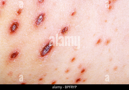 Ein Bild von eine hochinfektiöse Krankheit, die durch Varizellen, ein ...