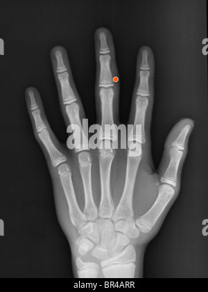 Röntgen der Hand eines 9 jährigen Jungen enthüllt seine Knochenalter ...