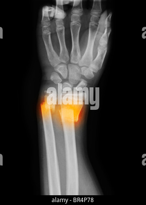 Distalen Radius und Ulna Fraktur mit Hubraum Stockfotografie - Alamy