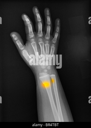 Unterarm Röntgen zeigen eine distale Radius Fraktur in ein 14 Jahre ...