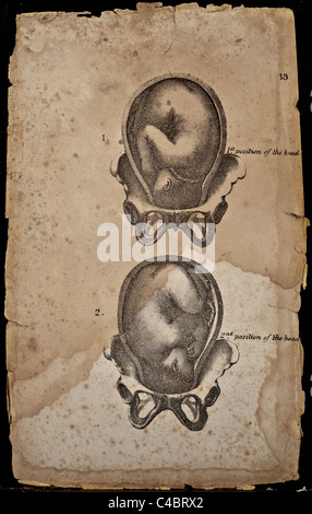 Fetus-Positionen in der Gebärmutter, Illustration Stockfotografie - Alamy