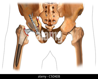 Posterior Acetabulum Fraktur Stockfotografie - Alamy