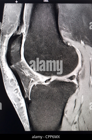Menschlichen Knie MRT zur medizinischen Diagnostik Stockfoto, Bild ...