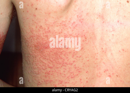 Allergische Kontaktekzem (Dermatitis) Ausschlag am Bauch des Patienten ...