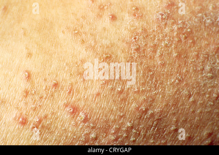 PITYRIASIS RUBRA PILARIS Stockfotografie - Alamy