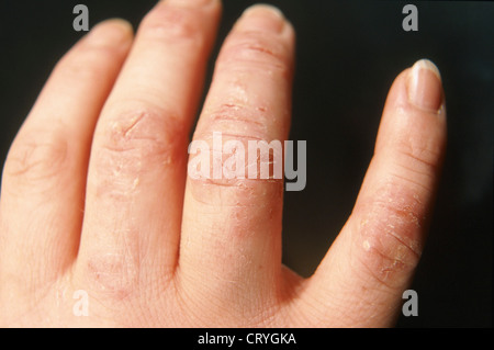 Allergische Kontaktekzem (Dermatitis) Ausschlag am Bauch des Patienten ...