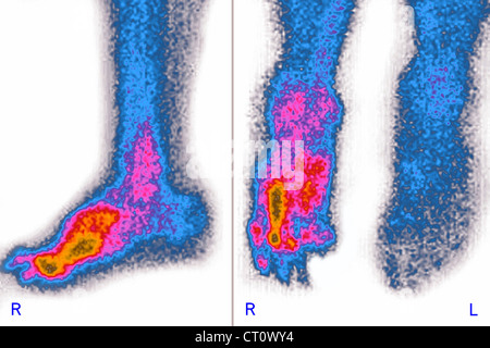 PERFORIERENDE ULCUS BEI DIABETES Stockfotografie - Alamy