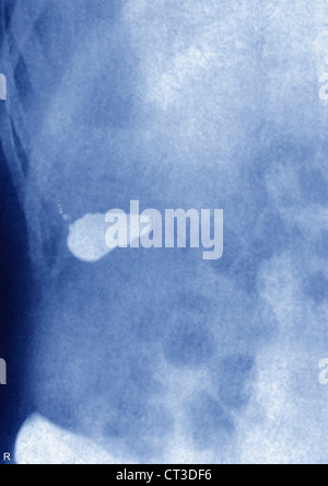 SUBPHRENIC ABSZESS, X-RAY Stockfotografie - Alamy
