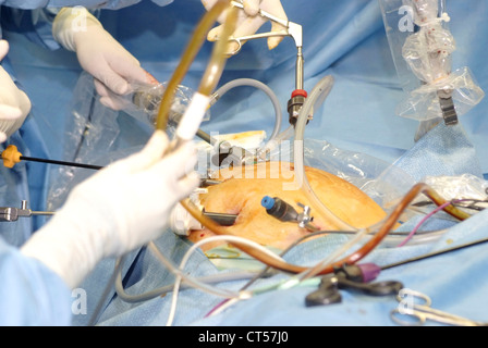 REKTALE RESEKTION LAPAROSKOPIE Stockfotografie - Alamy