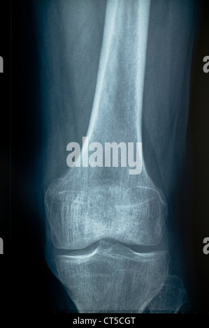 Röntgen der beiden menschlichen Knie (normale Knie Stockfoto, Bild ...