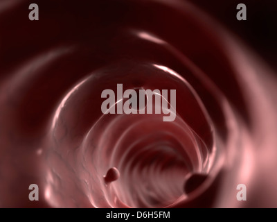 Menschlichen Dickdarm Polypen, Abbildung Stockfotografie - Alamy