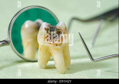 Anatomie der Zähne mit Karies Stockfotografie - Alamy