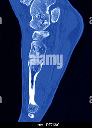Röntgen-Ansicht des menschlichen Fußes Stockfoto, Bild: 57642343 - Alamy