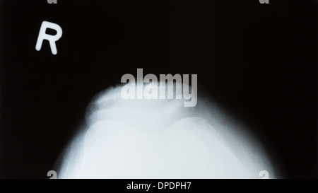 X-ray Foto oder Röntgen-Bild von einem menschlichen Knie mit Tibia ...