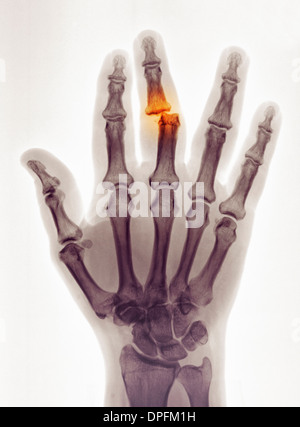 Hand-Röntgenaufnahme zeigt eine Luxation des proximalen ...