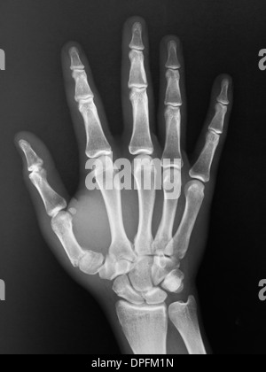 Röntgen der Hand eines 9 jährigen Jungen enthüllt seine Knochenalter ...