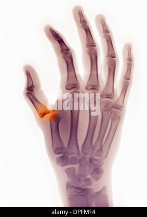 Hand-Röntgenaufnahme zeigt eine Luxation des proximalen ...
