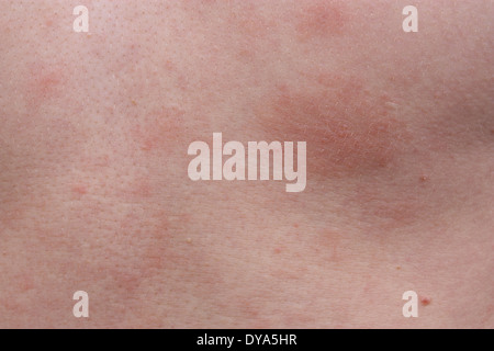 Hautallergie Hautausschlag oder Sonne Stockfoto, Bild: 70053048 - Alamy