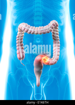 Dickdarm oder Kolon menschlichen Darm Illustration als ein ...