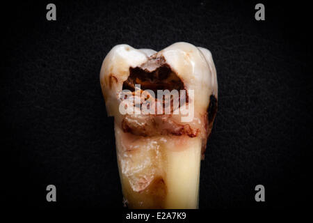 Der Zahn hat ein großes Loch und hat tief gelitten Stockfotografie - Alamy