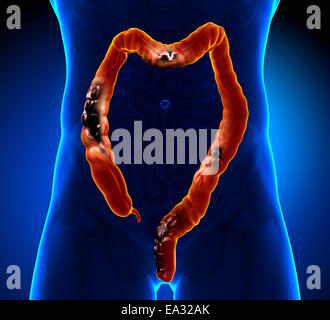 3D-Darstellung der dickdarmpolypen. Polypen im Darm. Weiß isoliert ...