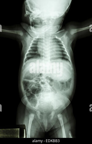 Film x-ray kindlichen Körper (normales Baby Stockfoto, Bild: 89060226 ...