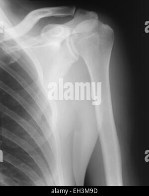 Die Knochen der Schulter Stockfotografie - Alamy