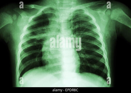 Lungentuberkulose. Röntgen-Thorax: Rechte Lunge Atelektase und ...
